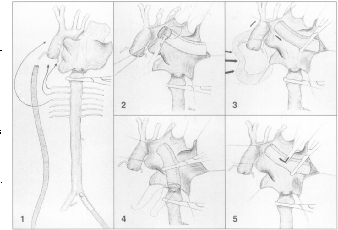 Repair Of Descending Thoracic Aneurysms Through A Left Posterolateral