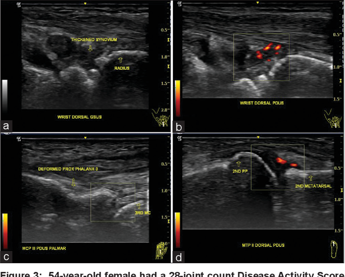 Figure 1 From The Relationship Between Us7 Ultrasound Joint Scoring