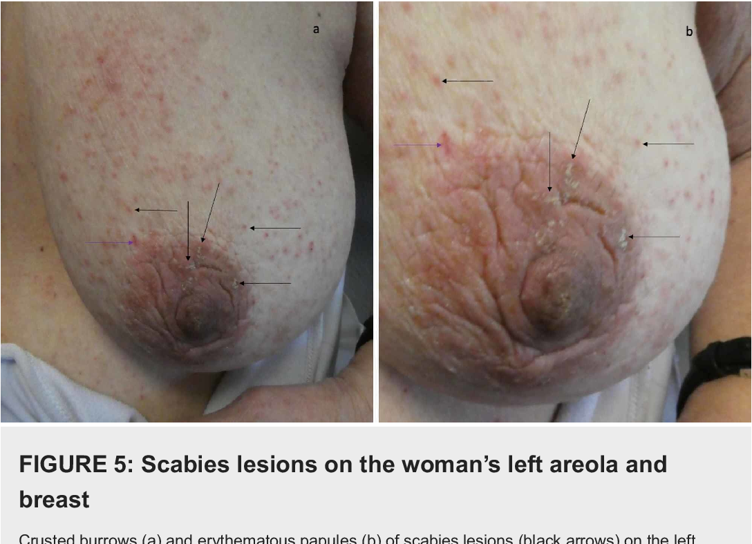 Figure 1 From Classic And Non Classic Surrepticius Scabies