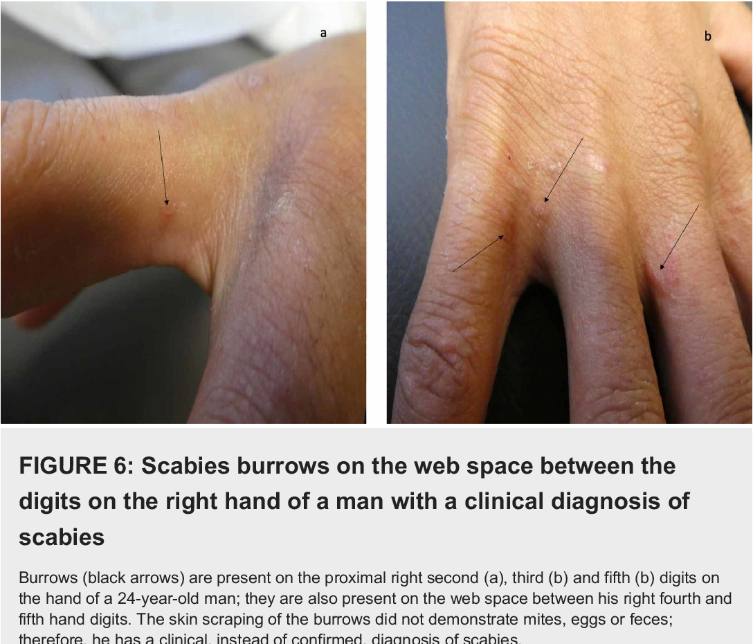 Figure 1 From Classic And Non Classic Surrepticius Scabies