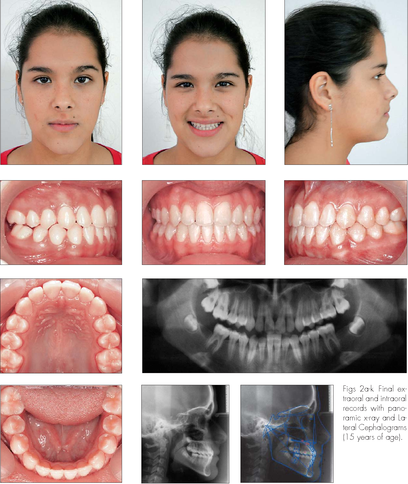 Severe Skeletal Class Iii With Biofunctional Technique 45 Off