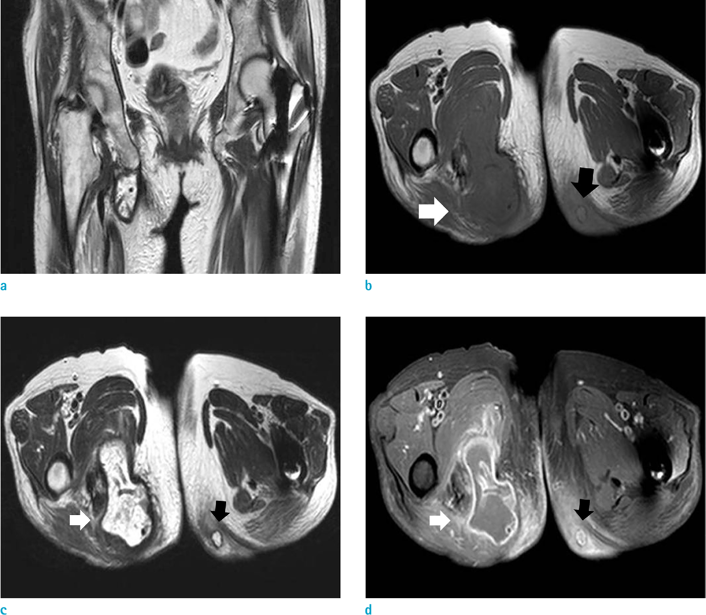 Ischial Bursitis