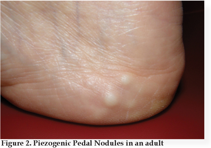 Piezogenic Pedal Papules