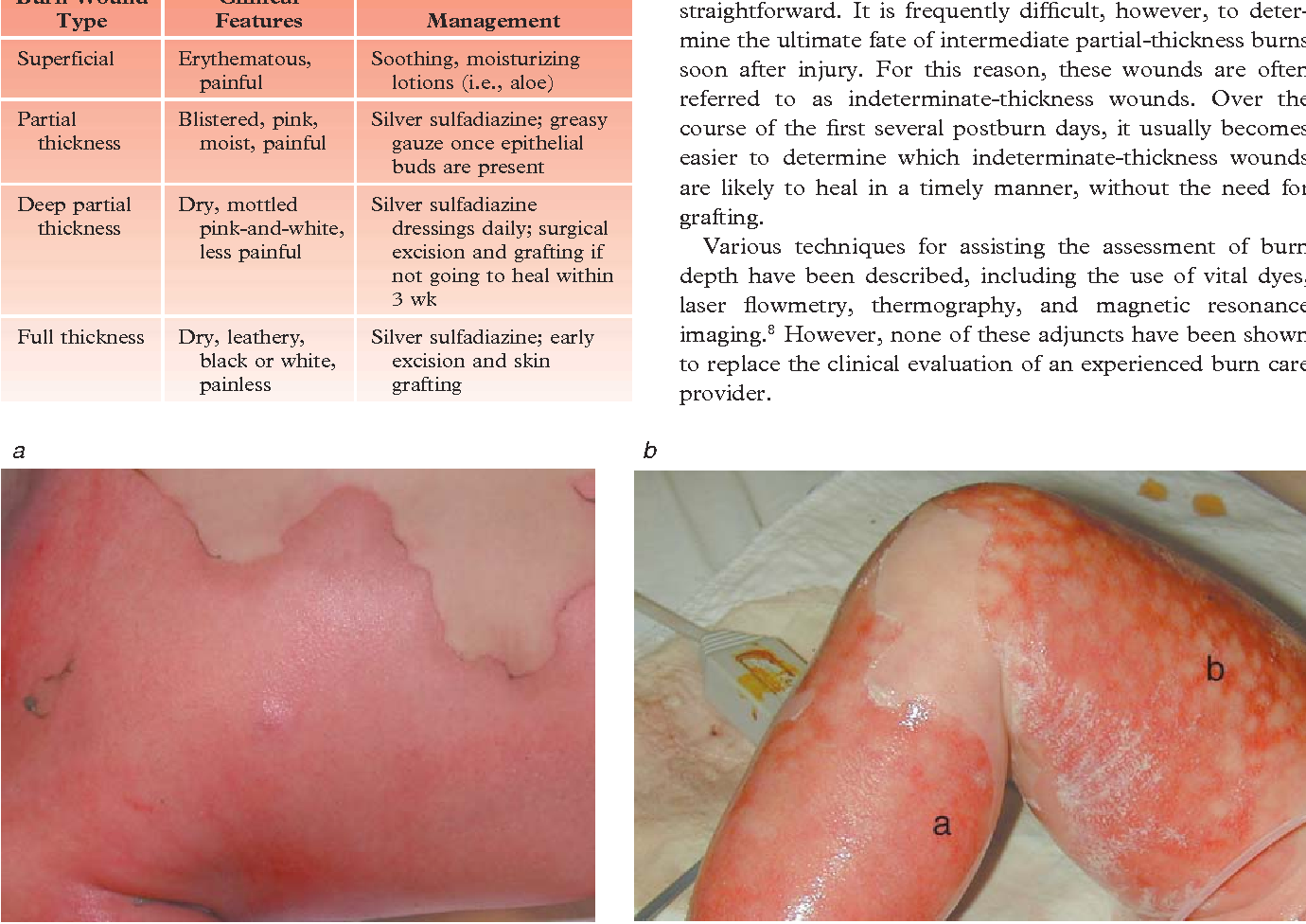 Figure 4 From Management Of The Burn Wound Semantic Scholar