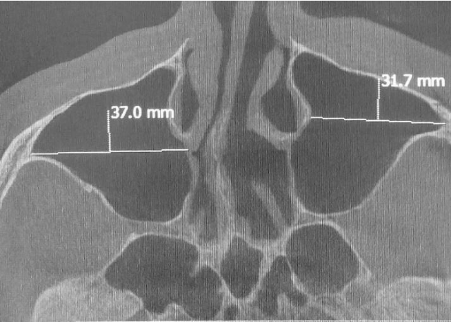 Figure 1 From Anthropometric Evaluation Of Volume Of Maxillary Sinus