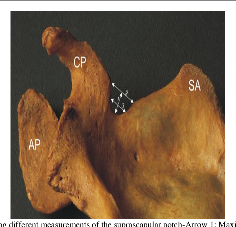 Figure 1 From Morphological Variations In Anatomy Of Suprascapular