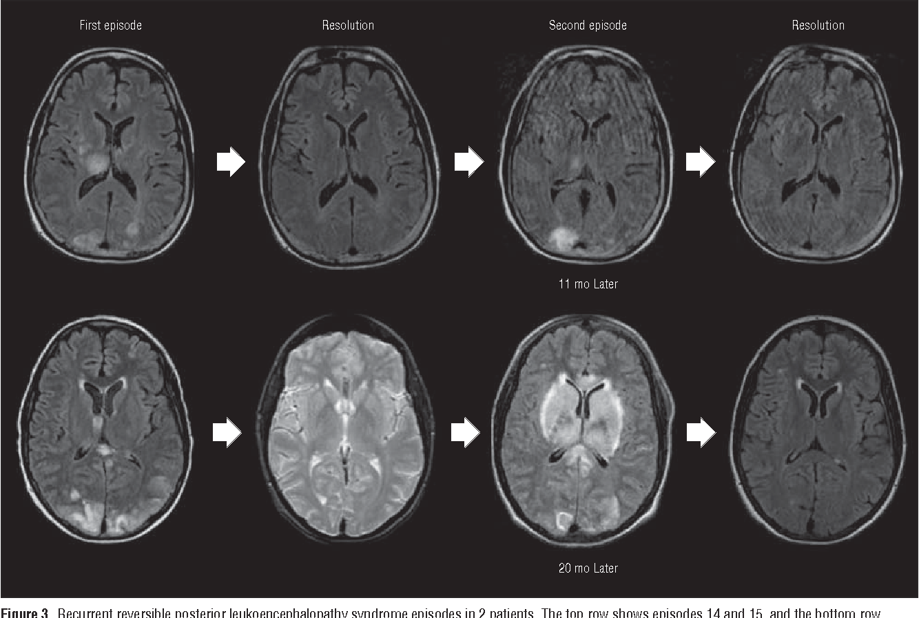 Figure 3 From Clinical Spectrum Of Reversible Posterior