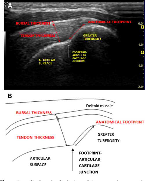 Rotator Cuff Ultrasound Images