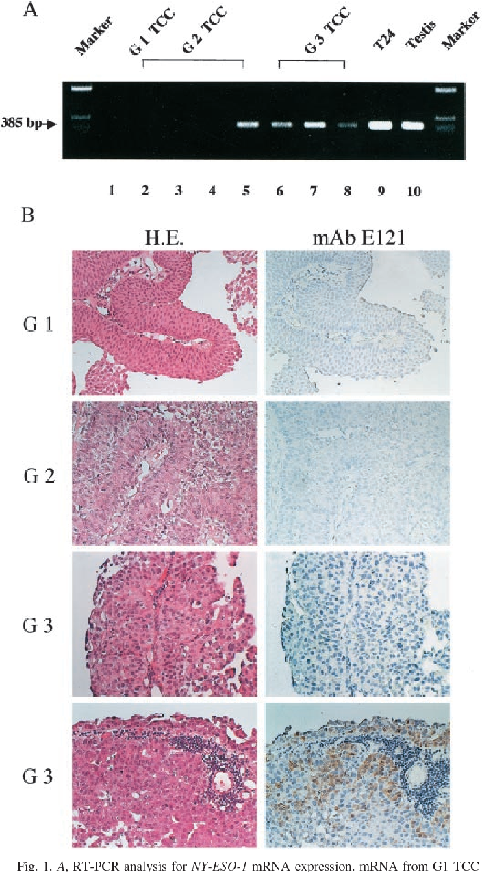 Figure 1 From Ny Eso 1 Expression And Immunogenicity Associated With