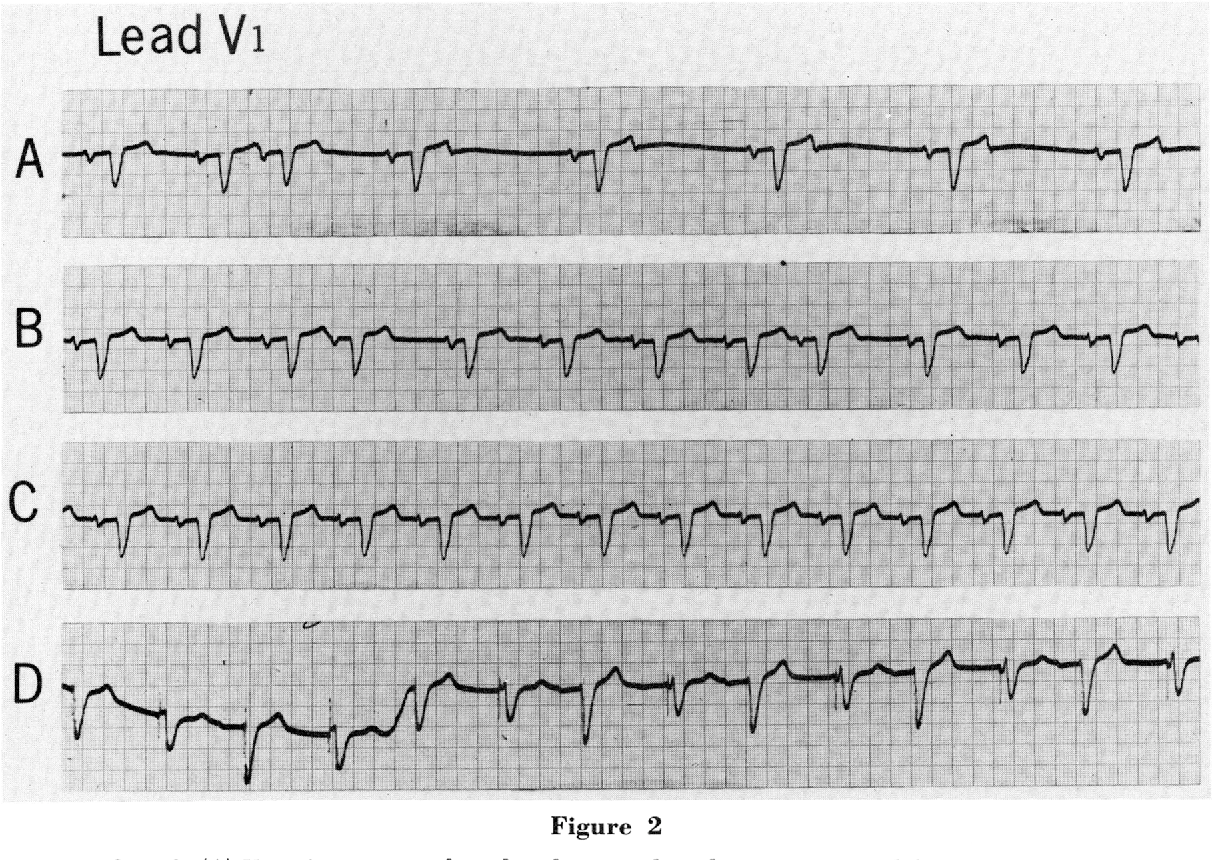 Possible Ectopic Atrial Bradycardia