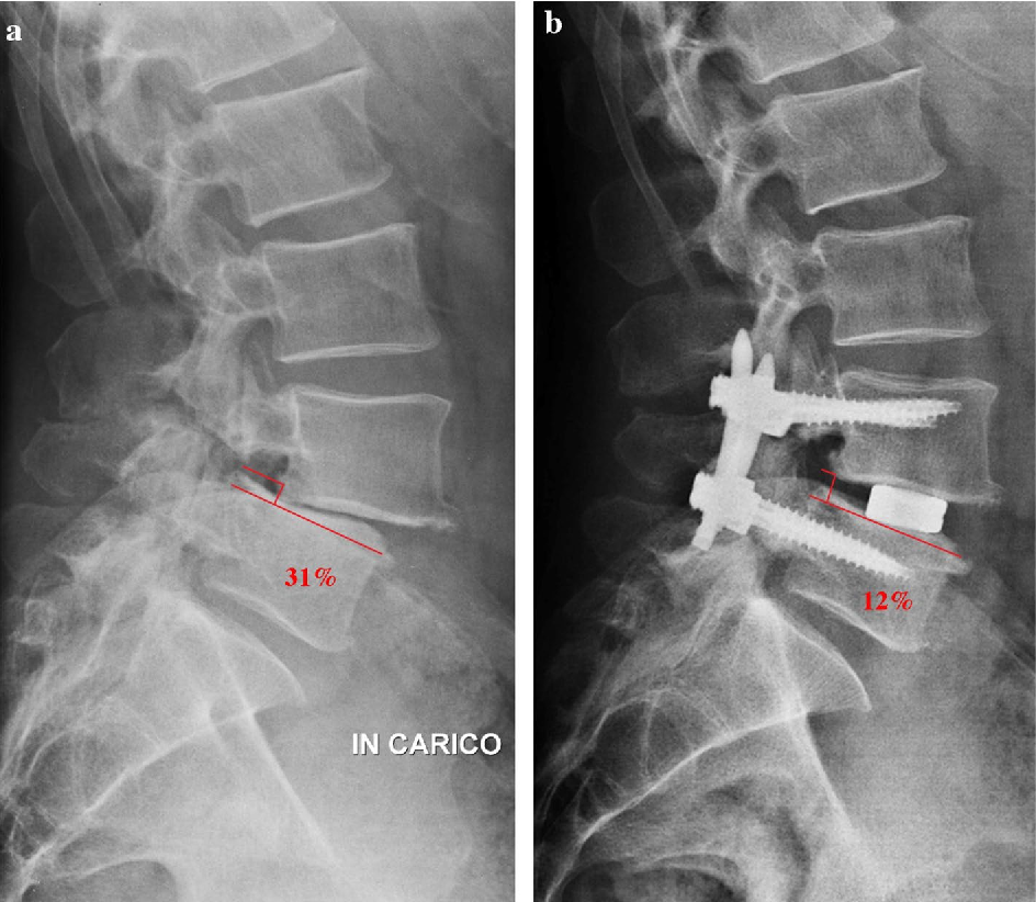 Figure From Minimally Invasive Treatment Of Lateral My Xxx Hot Girl