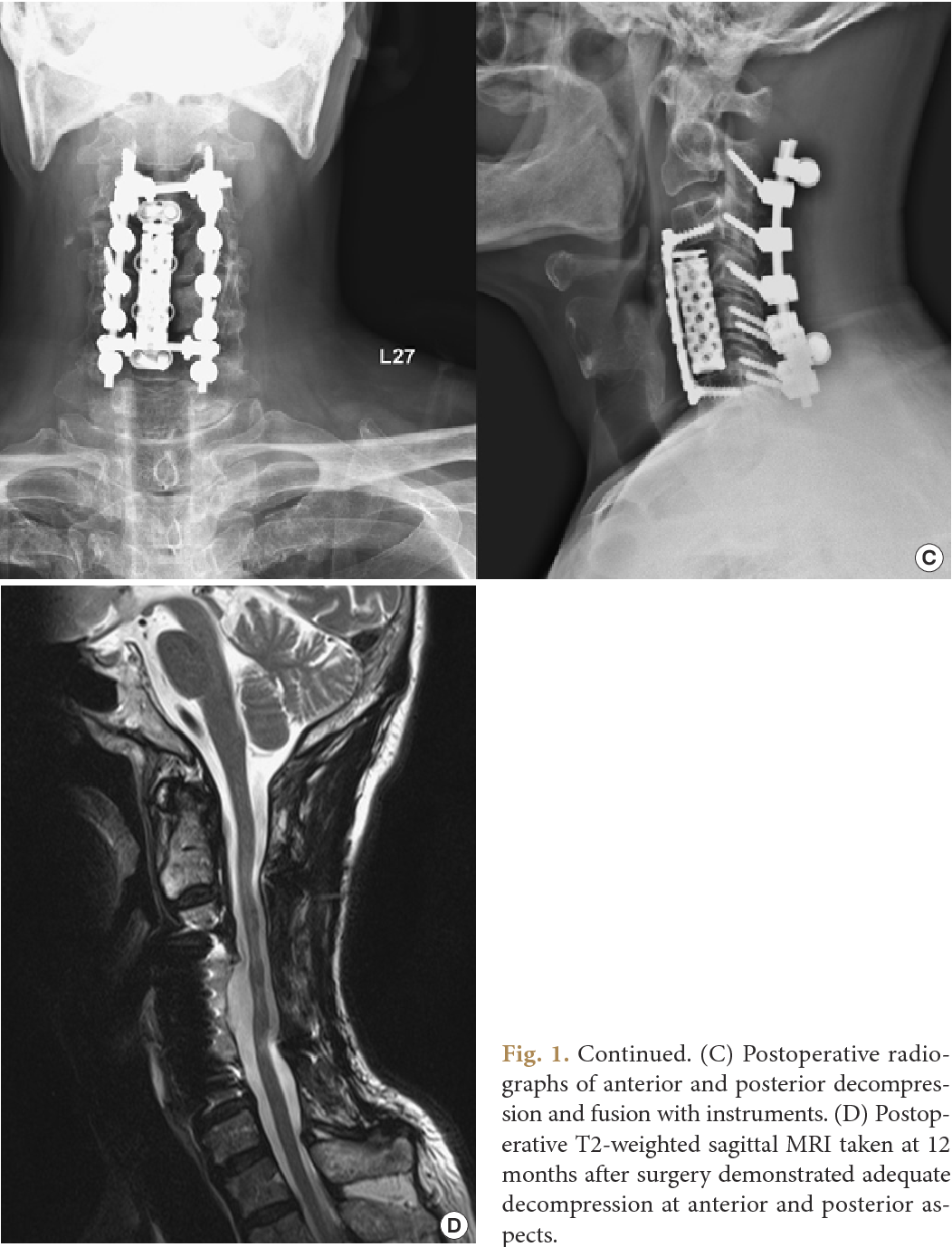 Ossification Of The Posterior Longitudinal Ligament O