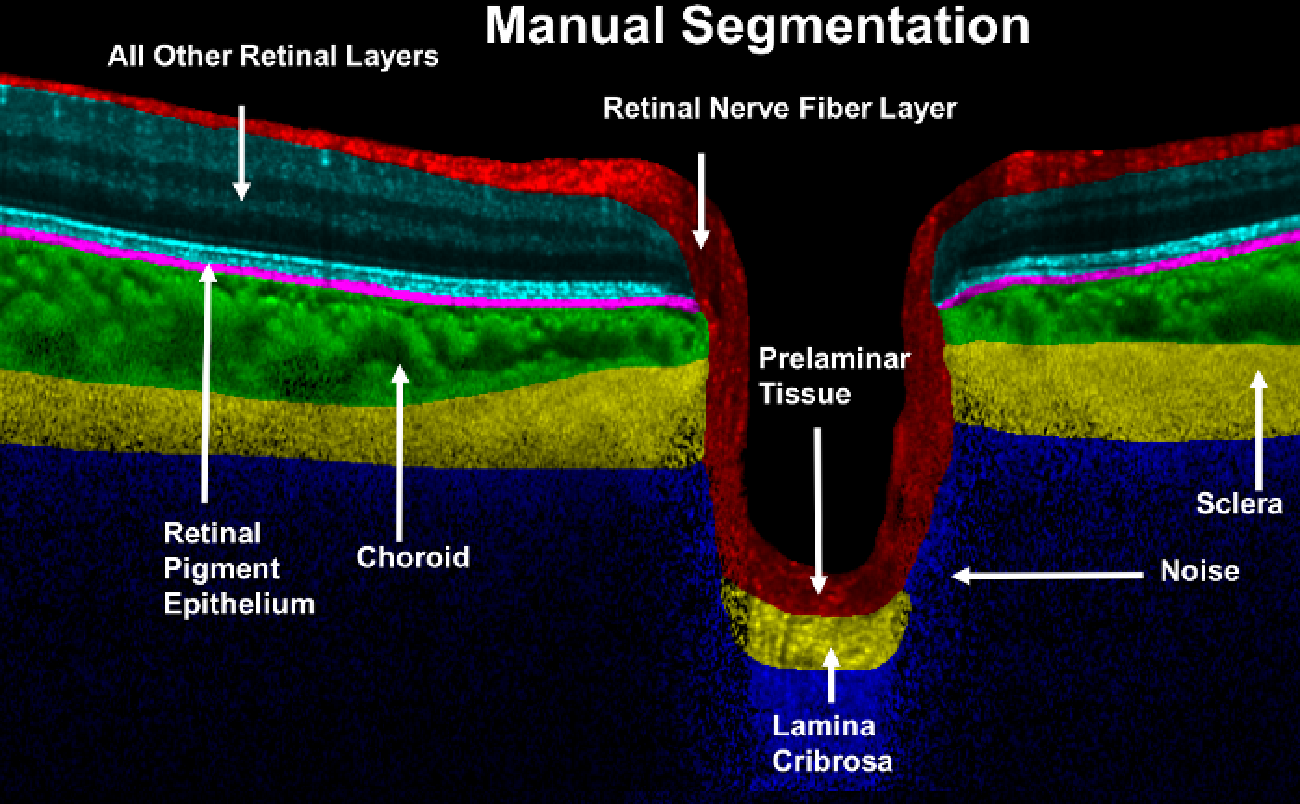 Optical Coherence Tomography Of The Optic Nerve Head And Retinal Nerve