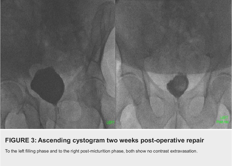 Pdf Laparoscopic Repair Of Catheter Induced Intra Peritoneal Bladder