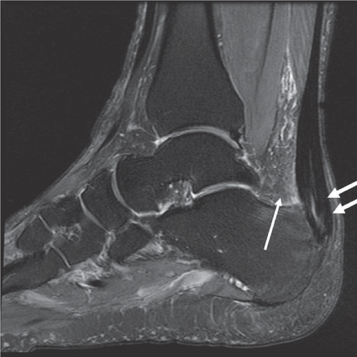 Insertional Achilles Tendonitis Mri