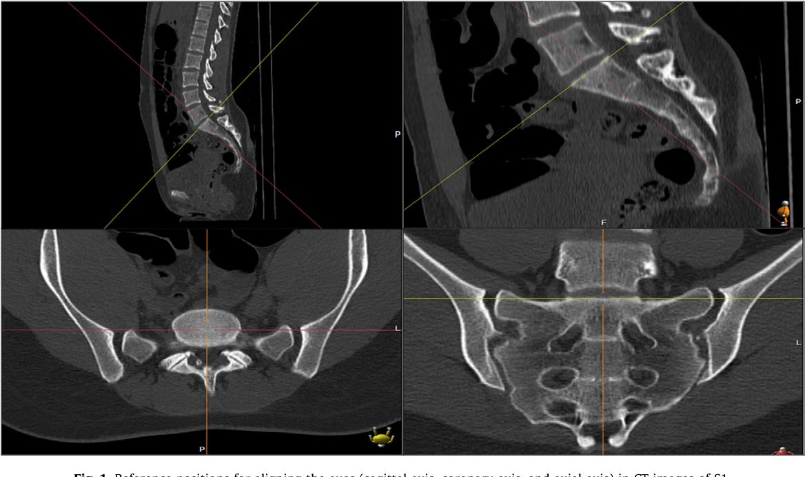 Figure 2 From Sex Determination From Os Sacrum By Postmortem Ct