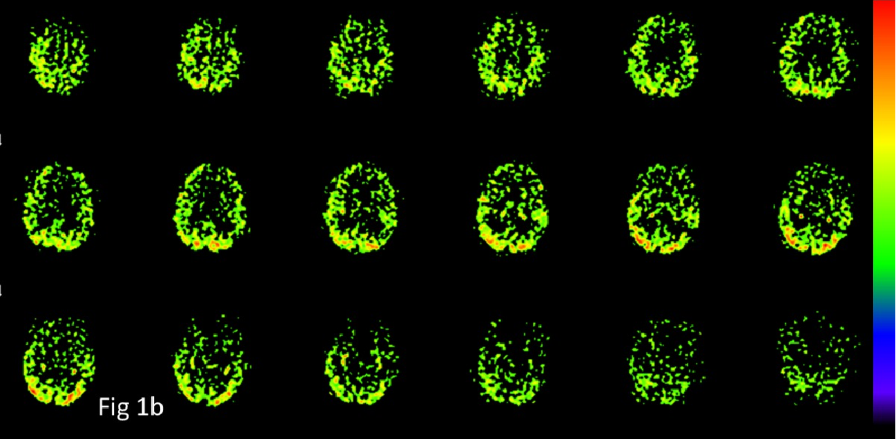 Figure 4 From Assessment Of Cerebral Blood Flow Using Multiphase 3d