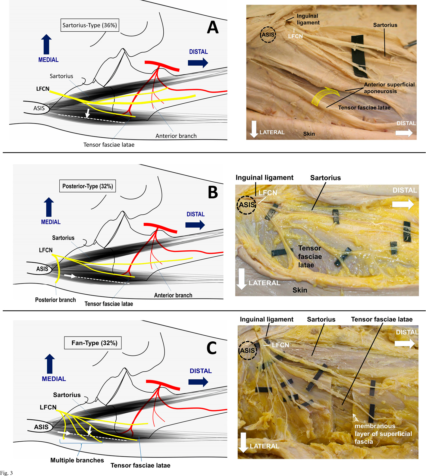 Lateral Femoral Cutaneous Nerve Treatment