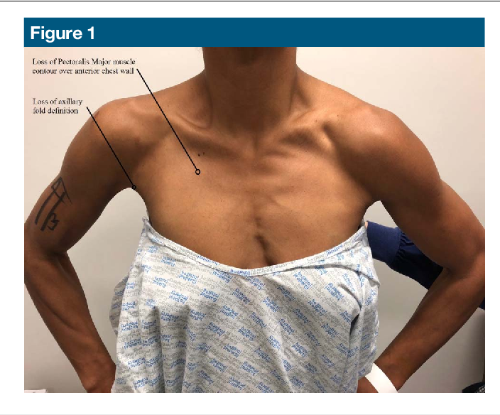 Pdf Pectoralis Major Rupture In An Active Female Semantic Scholar