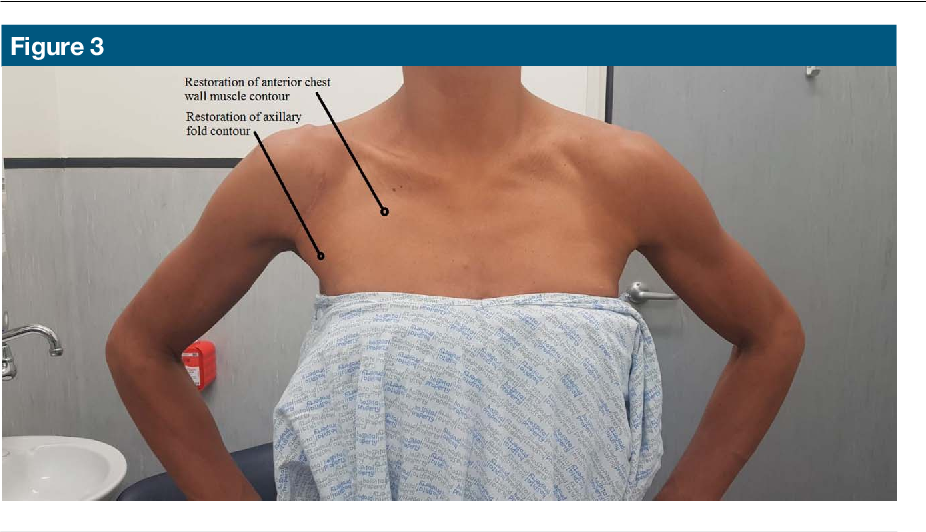 Figure 4 From Pectoralis Major Rupture In An Active Female Semantic