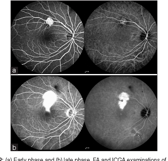 Retinal Pigment Epithelium Tear In An Idiopathic Acute Onset Bullous