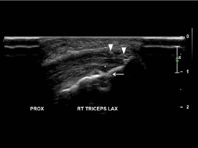 Ultrasonic Percutaneous Tenotomy For Recalcitrant Calcific Triceps