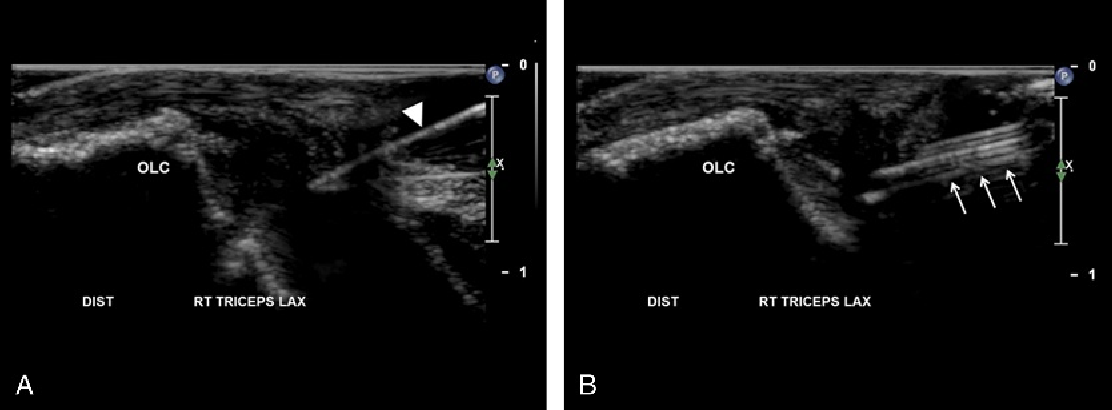 Ultrasonic Percutaneous Tenotomy For Recalcitrant Calcific Triceps