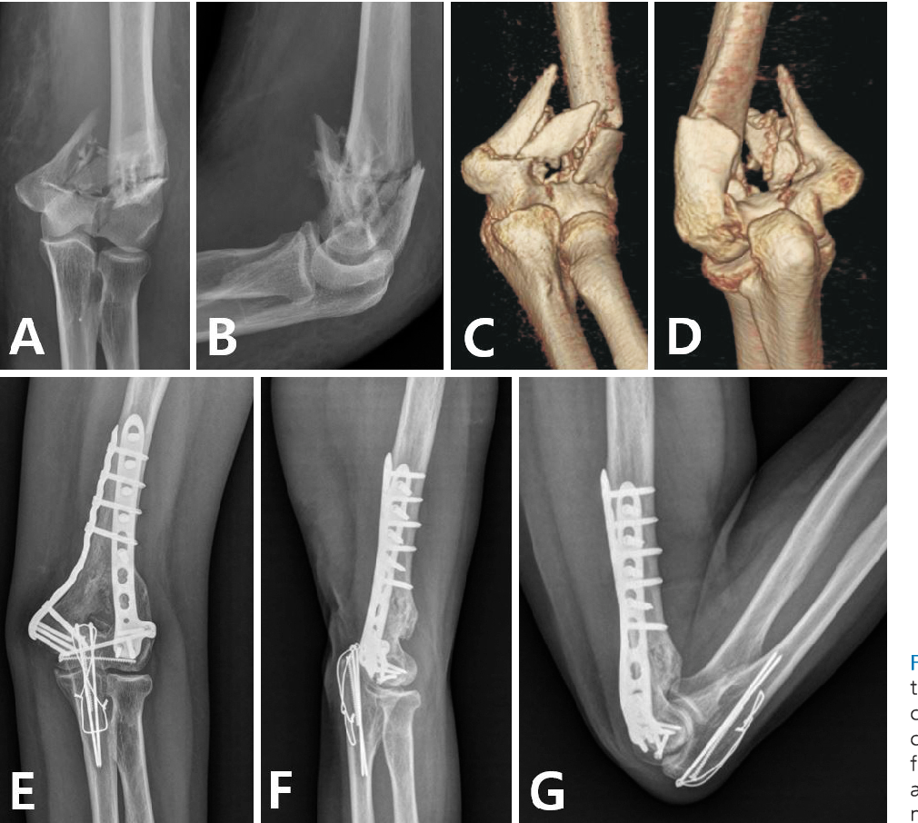 Figure 1 From Distal Humerus Fracture How To Choose The Approach