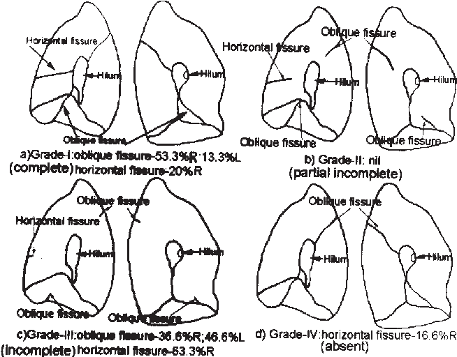 Pdf Morphological Variations Of The Lung Fissures And Lobes