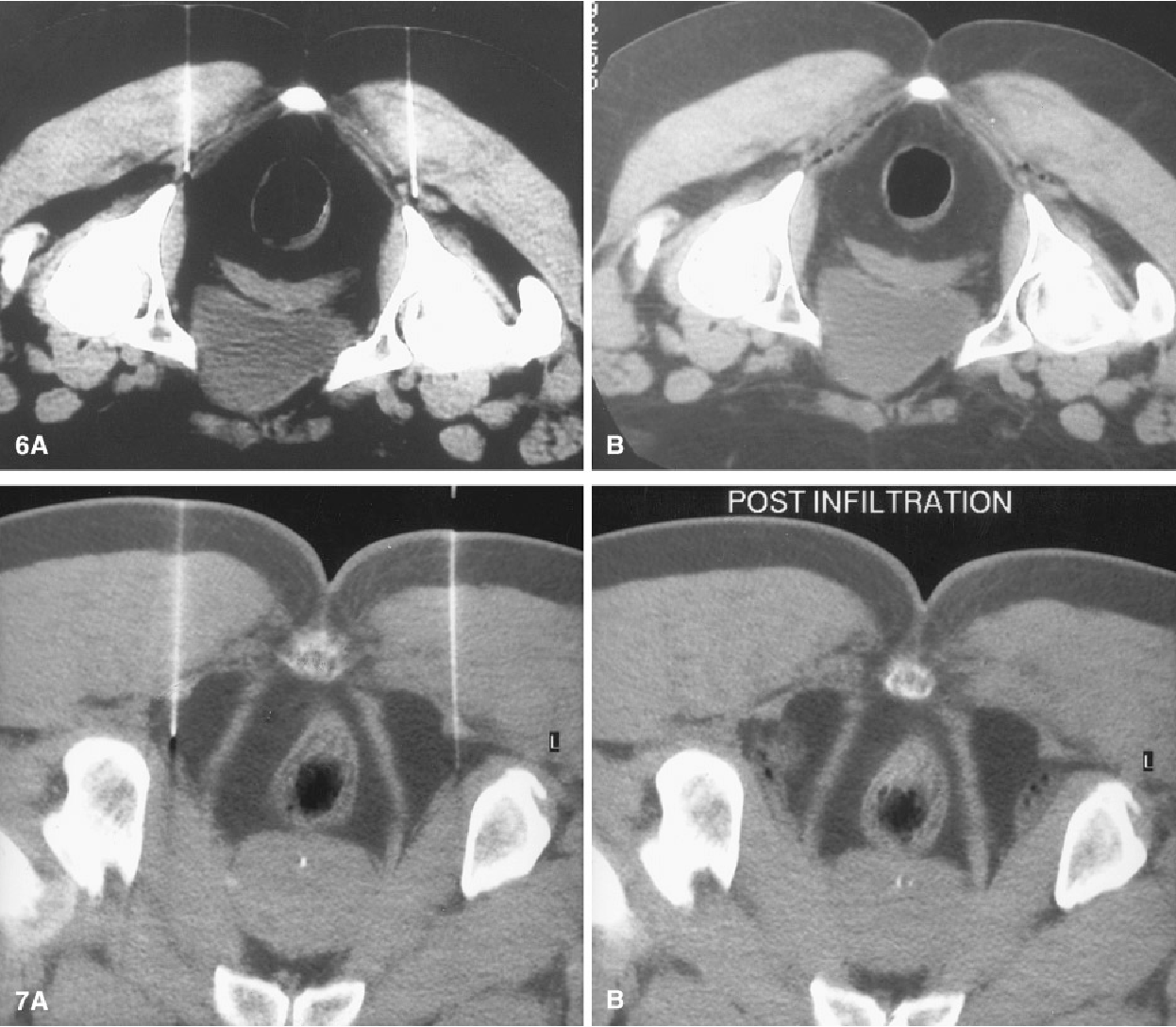 Pdf Pudendal Neuralgia Ct Guided Pudendal Nerve Block Technique