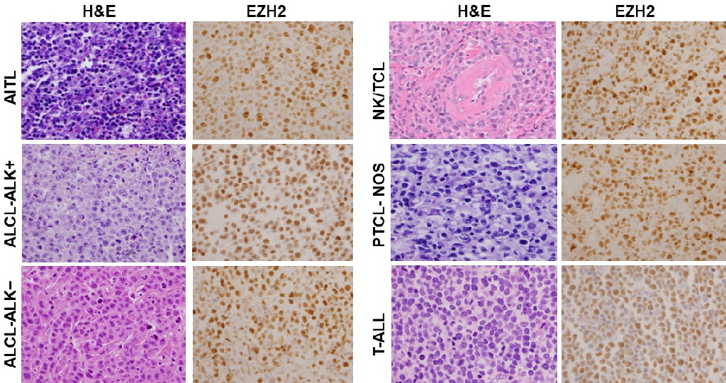 Pdf Upregulation Of Enhancer Of Zeste Homolog 2 Ezh2 With