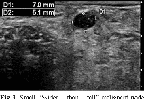 Pdf Ultrasonography Of Superficial Lymph Nodes Benign Vs Malignant