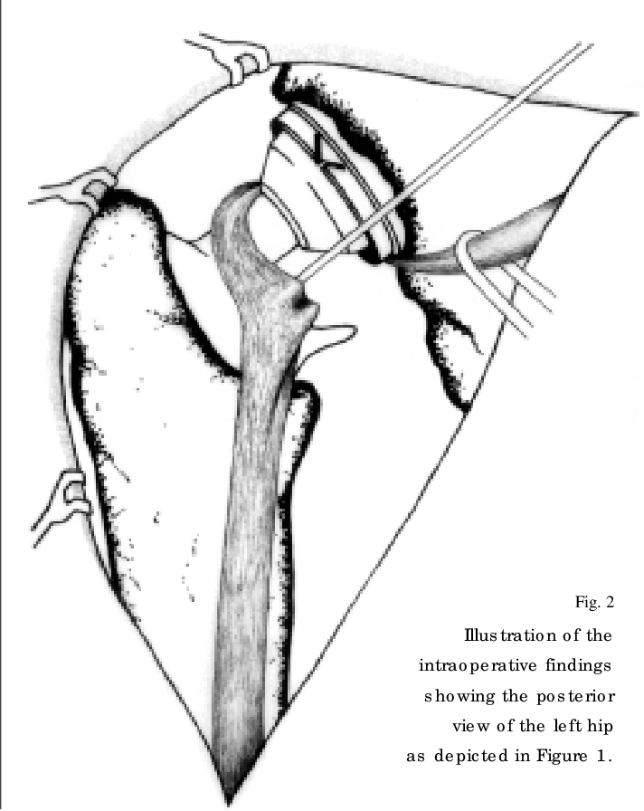 Figure 2 From Entrapment Of The Sciatic Nerve By The Femoral Neck