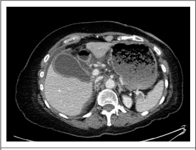 Figure 1 From Primary Gallbladder Lymphoma Presenting With Perforated