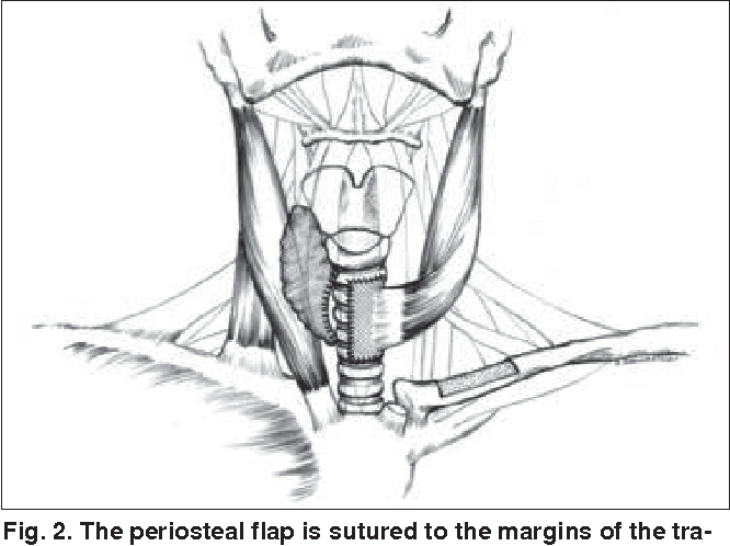 Figure 1 From The Sternocleidomastoid Myoperiosteal Flap For The