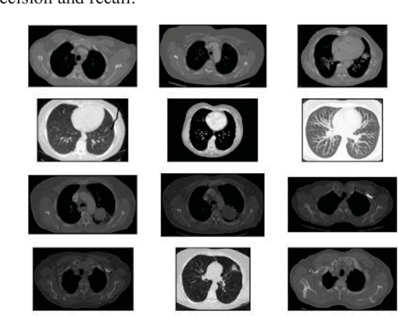 Figure 3 From Deep Learning Model For Lung Cancer Detection On Ct Scan