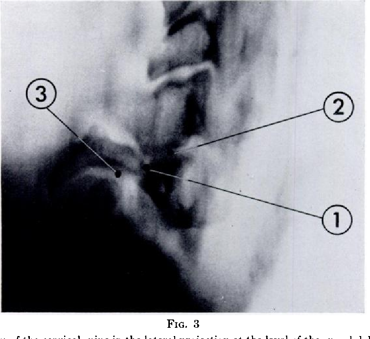 Figure 3 From Unilateral Spondylolysis Of The Sixth Cervical Vertebra