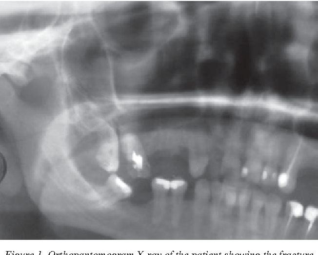 Maxillary Tuberosity Fracture