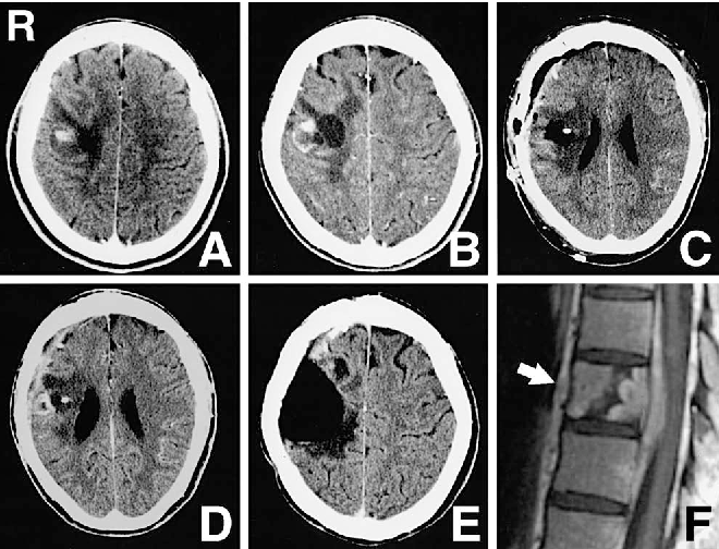 Figure 1 From Frontal Anaplastic Oligodendroglioma Showing Multi Organ