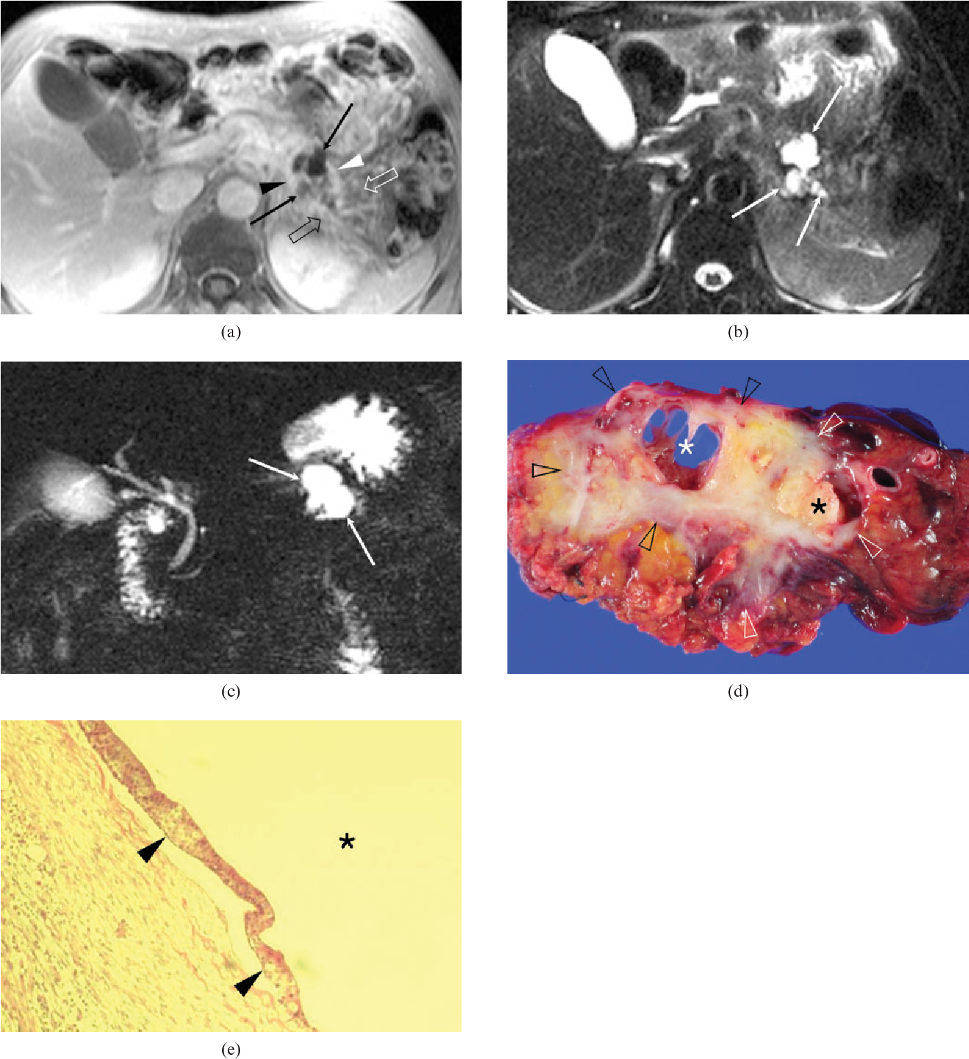 Figure 1 From Pancreatic Ductal Adenocarcinoma With Intratumoral Cystic