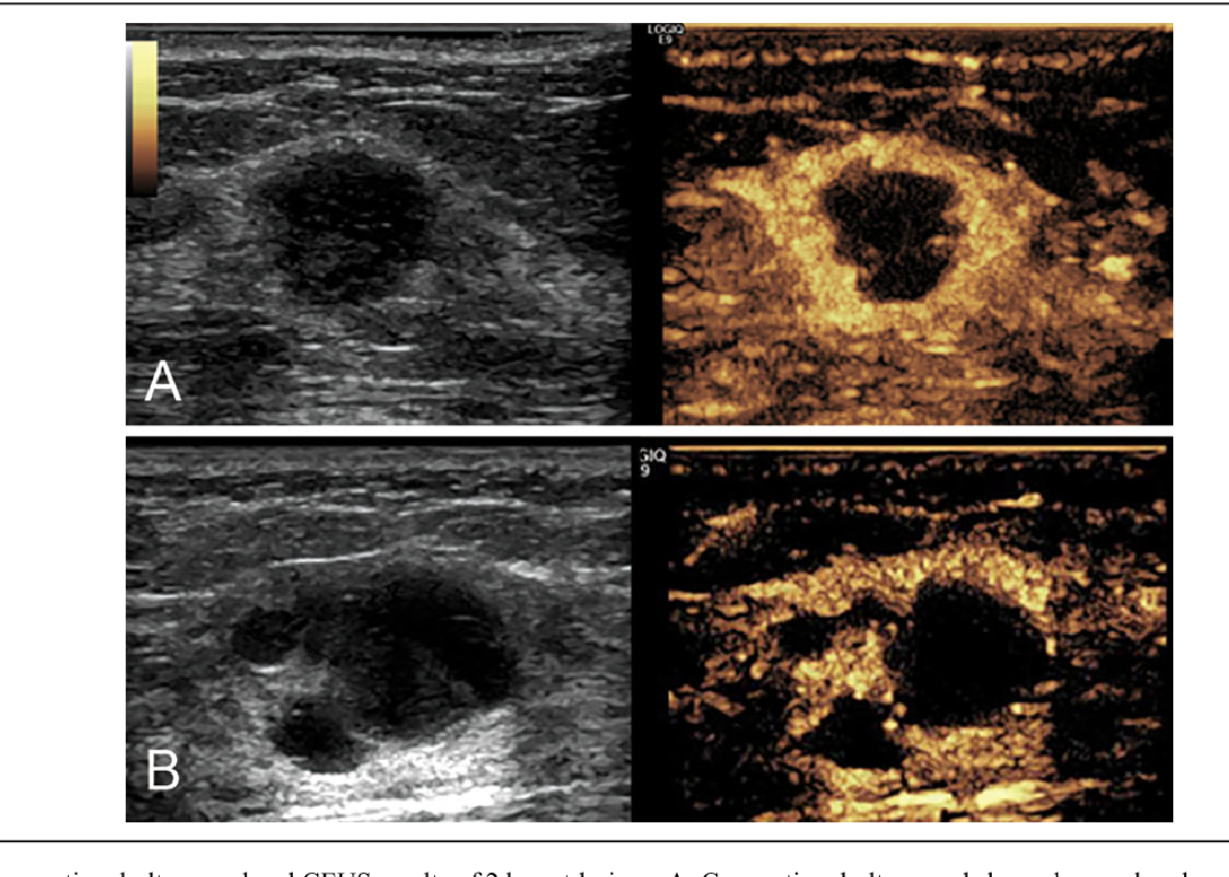 Figure 1 From Diagnostic Value Of Contrast Enhanced Ultrasonography