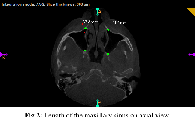 Figure 1 From Gender Determination Of Maxillary Sinus Using Cbct