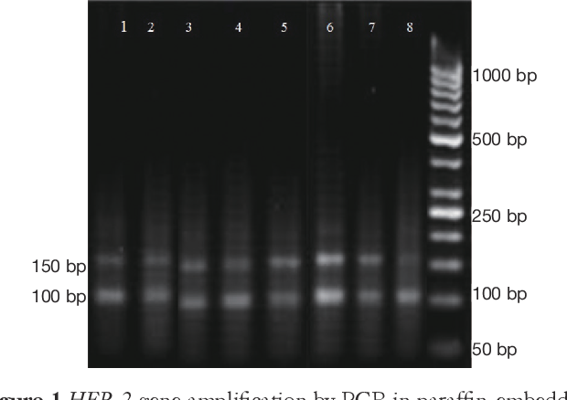 Her 2neu Gene Amplification In Gastric Adenocarcinoma And Its