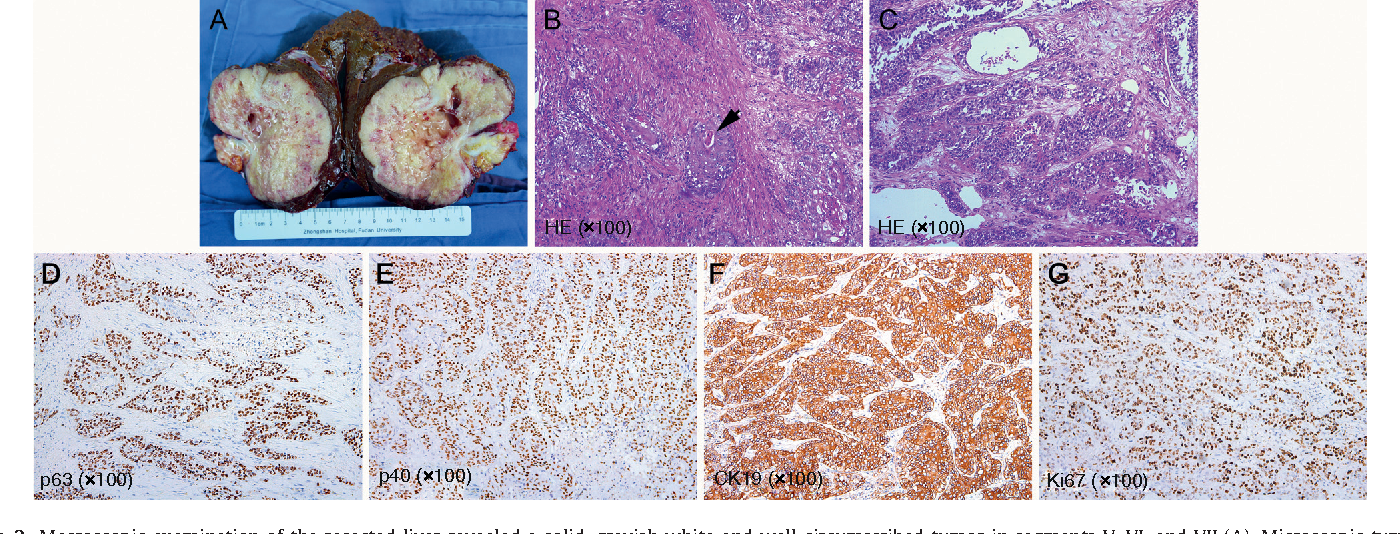 18f Fdg Petct In A Case Of Primary Hepatic Adenosquamous Carcinoma