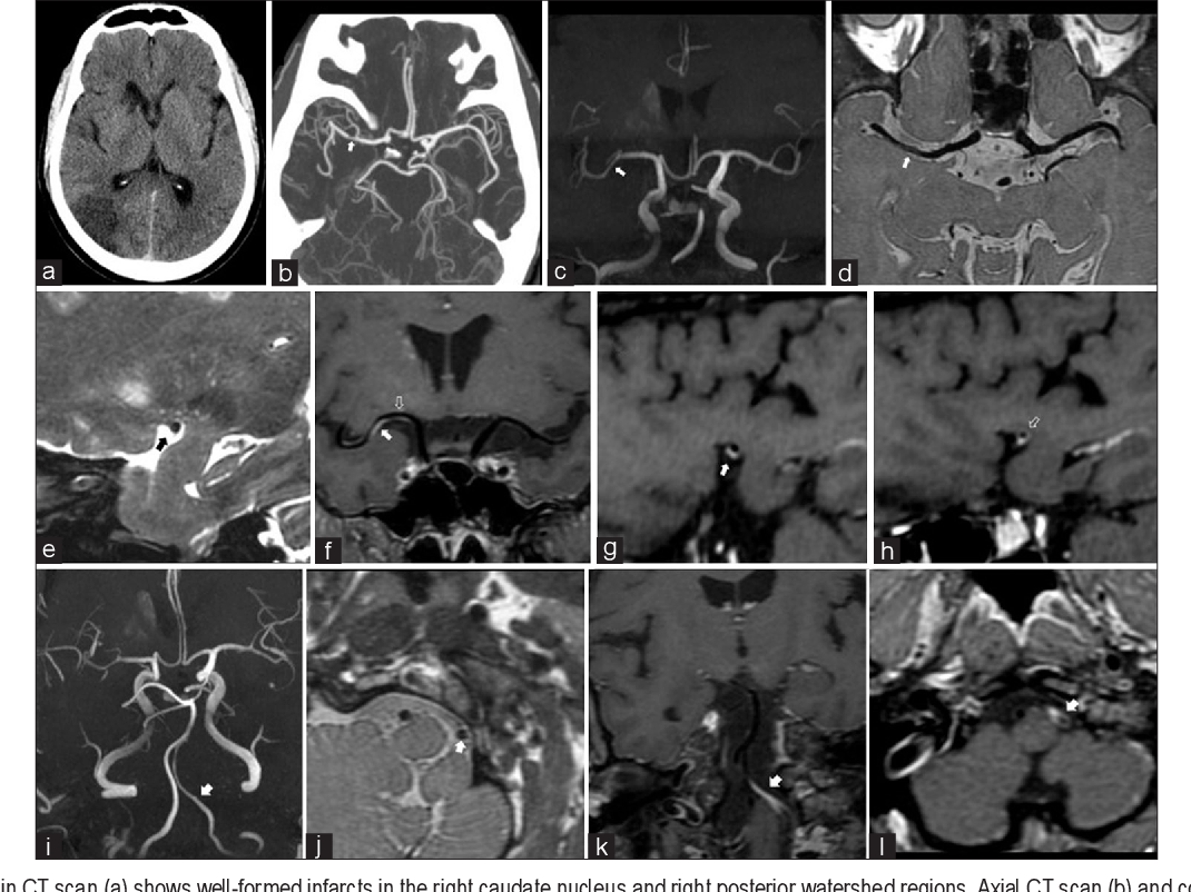 Figure 1 From Magnetic Resonance Vessel Wall Imaging In Intracranial