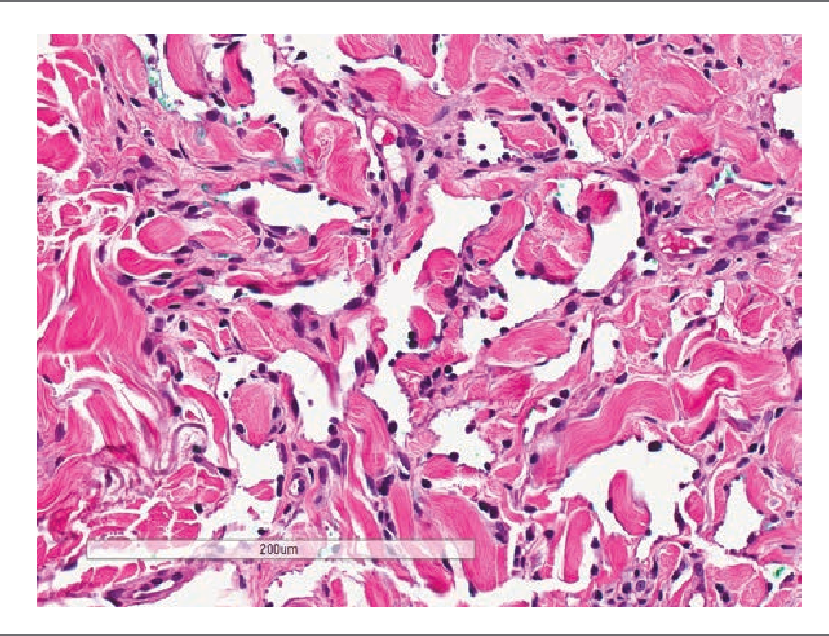 Figure 1 From A Case Of Patch Stage Of Kaposis Sarcoma And Discussion