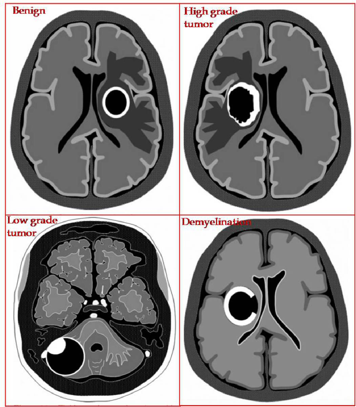 Figure 2 From Differential Diagnosis Of Ring Enhancing Lesions In