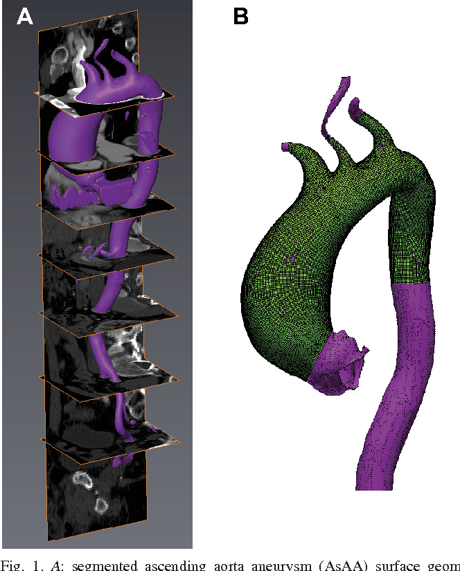 Figure 2 From Patient Specific Finite Element Analysis Of Ascending