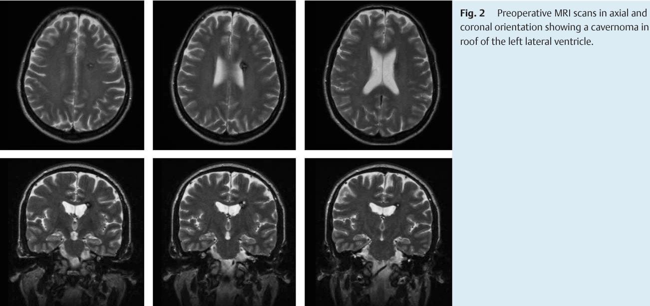 Minimally Invasive Cerebral Cavernoma Surgery Using Keyhole Approaches