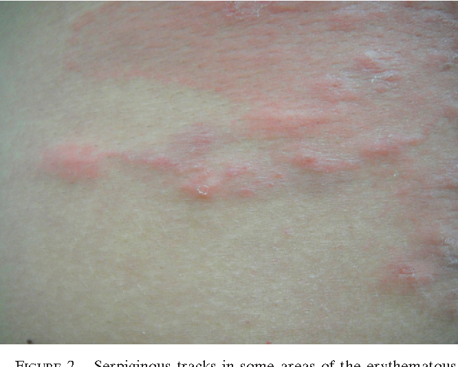 Cutaneous Larva Migrans Symptoms